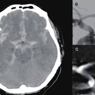 Computed Tomography Of The Head Showed Diffuse Subarachnoid Hemorrhage