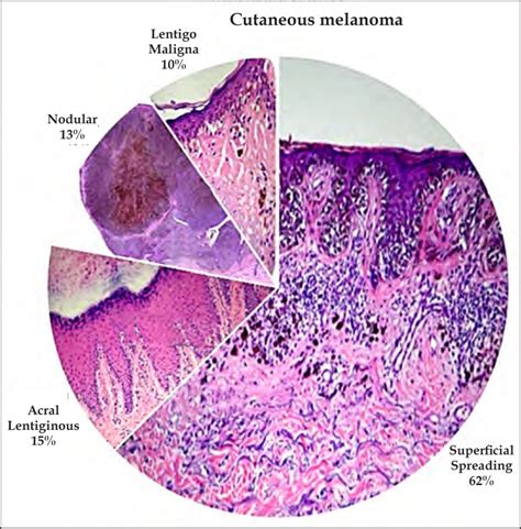 Melanoma Clinical Evolutive And Histopathological Characteristics Of