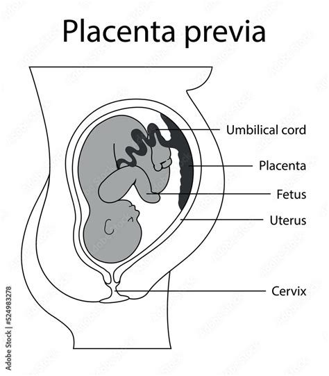 Placental Previa Fetus In Uterus During Pregnancy Pregnancy Women