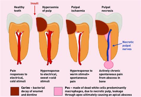 Schematic Representation Of Progression Of A Lesion Of Dental Caries