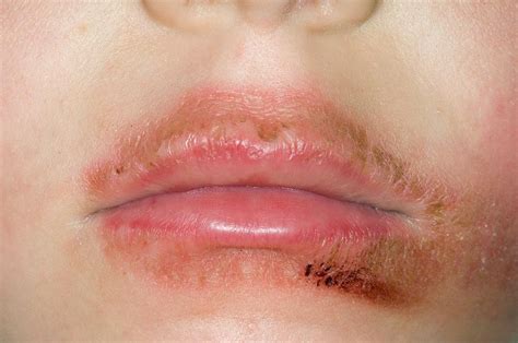 Dermatitis Around The Mouth Photograph By Dr P Marazziscience Photo Library
