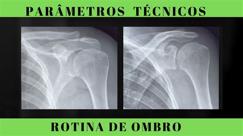 Rotina De Ombro Como Fica Melhor A Radiografia AP Corrigido X AP Sem