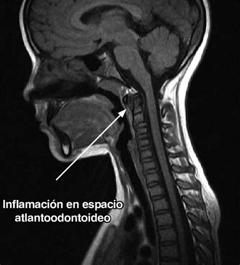 Resonancia magnética ponderada en T1 de la columna cervical en corte