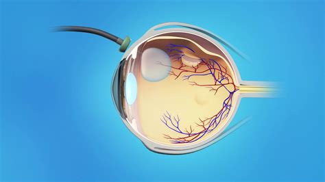 Retina Detached Vitrectomy YouTube