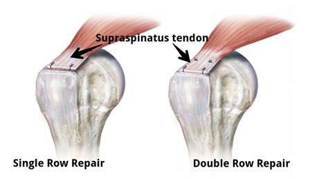 Is Early Physical Therapy Safe After A Rotator Cuff Repair Physio