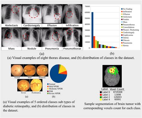 deep learning for analysis of imbalanced medical image datasets intel devmesh