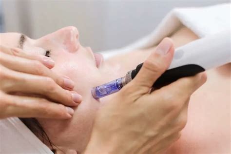 Dermapen Qué es para qué sirve y sus beneficios Virtus Estética