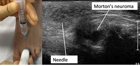 Morton S Neuroma Cortisone Injection Musculoskeletal Ultrasound