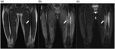 Magnetic Resonance Imaging Of The Left Thigh Showed A Slightly Low To