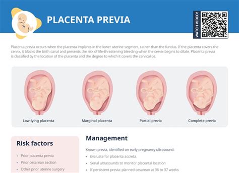 Placenta Previa Free Cheat Sheet Lecturio Nursing