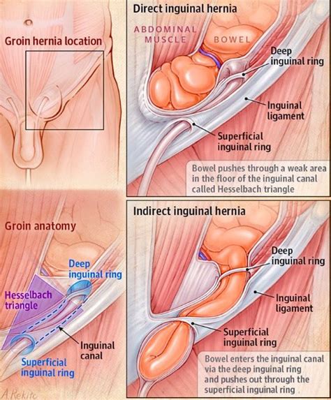 Direct Inguinal Hernia Anatomy