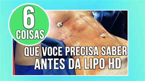 Coisas Que Voce Precisa Saber Antes De Fazer A Lipo Hd Cirurgia