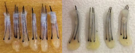 Infected Hair Follicle Transplant R Popping
