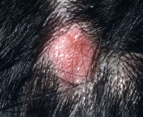 Ch Cutaneous Metastases Flashcards Quizlet