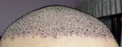 Hair Transplant Infections Causes Risks Treatment Explained By A
