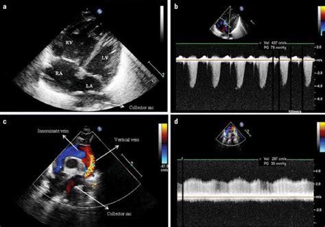 A D Echocardiographic Views A Four Chamber View With Emphasis On