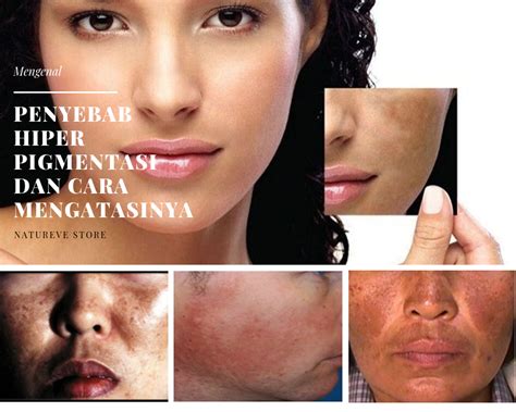 Mengenal Penyebab Hiperpigmentasi Dan Cara Mengatasinya