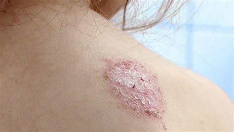 6 tipos de eczema causas sintomas e tratamento MD Saúde
