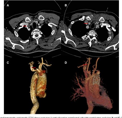 Pdf Hybrid Aortic Arch Procedure In Acute Type A Aortic Dissection