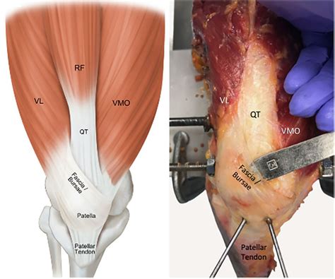Quadriceps Tendon Anatomy