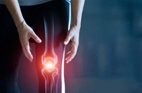 Osteoartritis De Rodilla S Ntomas Y Tratamiento Doctor Carlos Ochoa