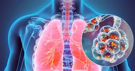 Por qué surge el brote de Legionella Infobae