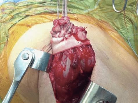Left Pectoralis Tendon Tear With Acellular Dermal Allograft Folded Over
