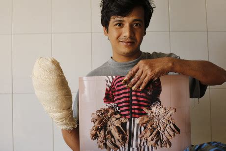 Epidermodysplasia Verruciformis Patient In Dhaka Bangladesh Jan