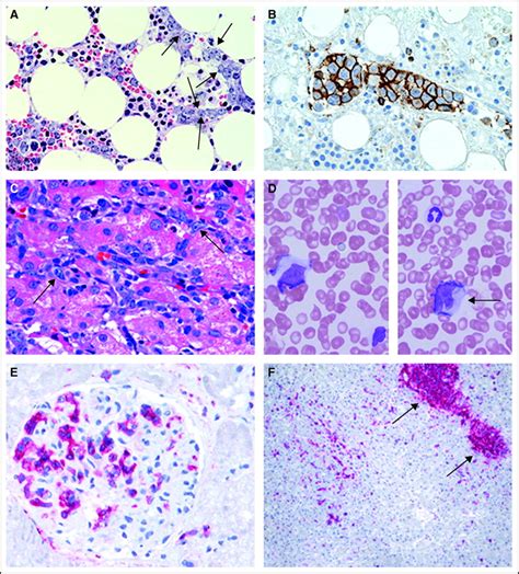 Definition Diagnosis And Management Of Intravascular Large B Cell