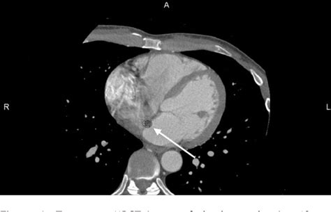 Figure 1 From Value Of CT Localization Of The Fossa Ovalis Prior To