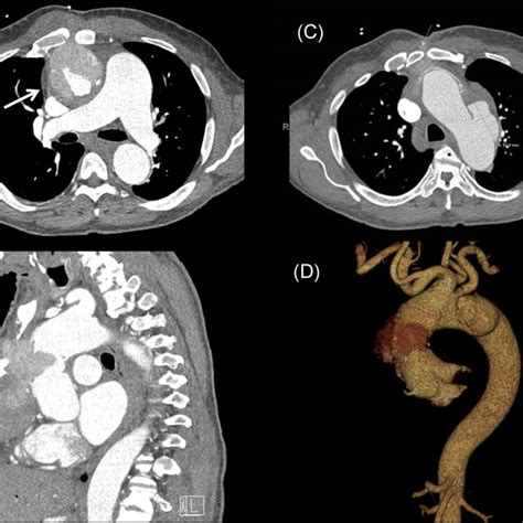 A Preoperative Computed Tomography Angiogram CTA Crosssectional