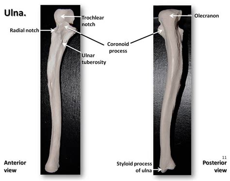 Ulna Anterior And Posterior Views With Labels Appendicu Flickr