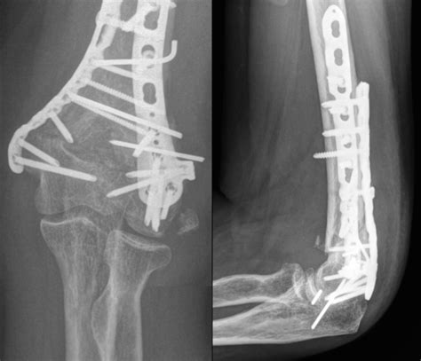 Fracture du coude Clinique Ostéo Articulaire des Cèdres Grenoble