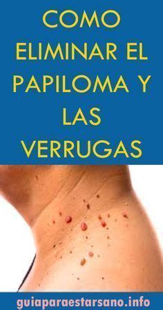 Remedios Naturales Para Eliminar Las Verrugas De Tu Cuerpo Artofit