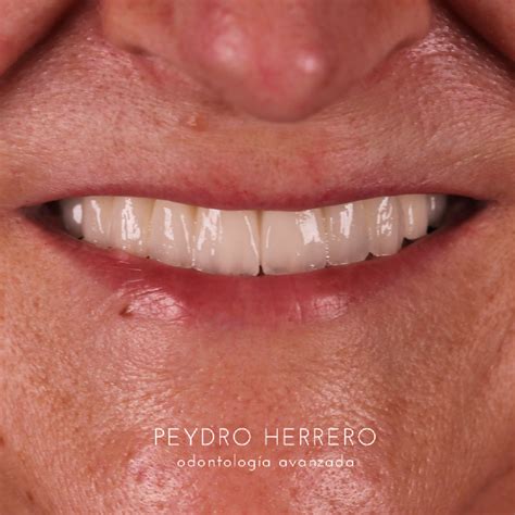 Implantes Dentales De Carga Inmediata En Valencia
