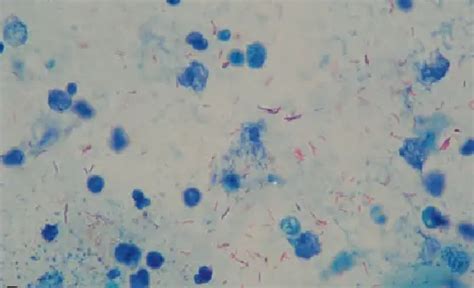 Ziehl Neelsen Stain Acid Fast Stain Principle Steps Interpretation