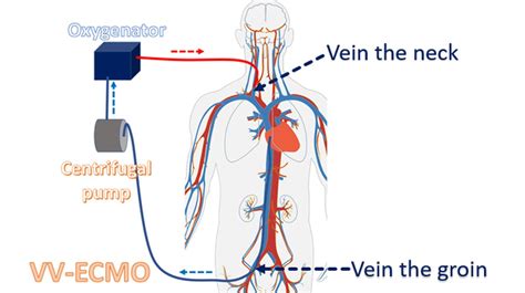 Open Chest Ecmo