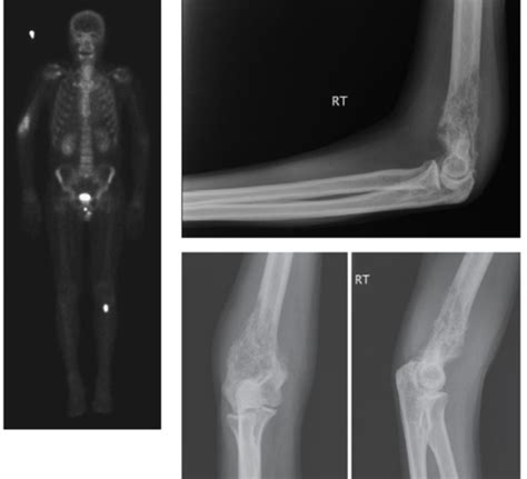 Upper Limb Pathology Flashcards Quizlet