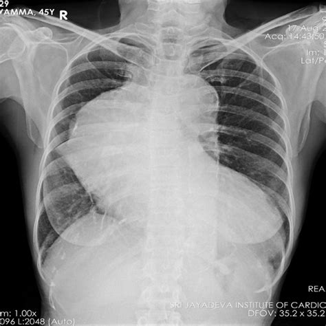 X Ray Images Of Aortic Tear