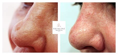 Vorher Nachher Galerie Skinline Aesthetics Swiss