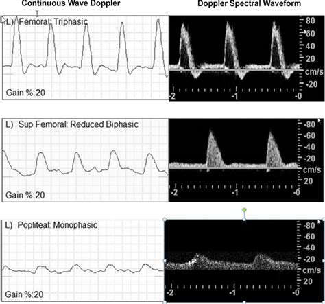 Arterial Waveform Ultrasound Vascular Ultrasound Medical Ultrasound