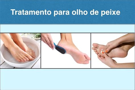 Tratamento Para Olho De Peixe Tua Sa De