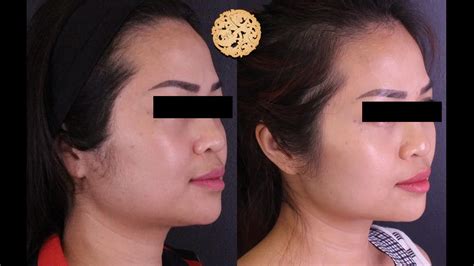 Buccal Fat Removal Before And After Gallery Dr Nazarian