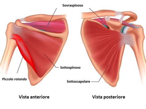 Lesione Della Cuffia Dei Rotatori