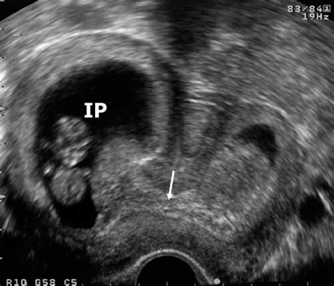 Week Ectopic Pregnancy Ultrasound