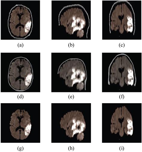 Automated Diagnosis Of Acute Cerebral Ischemic Stroke Lesions From