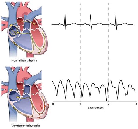 Ventricular Tachycardia Causes Symptoms Diagnosis Prognosis Treatment