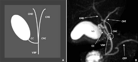 Figure 2 from Mapeamento Biliar Revisão da Anatomia Normal e das