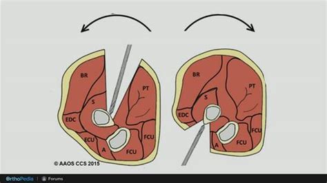 Innovations In Elbow Surgery Part 4Acute Distal Biceps Tendon