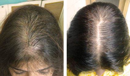 Tratamiento de la Alopecia con Plasma Rico en Plaquetas Clínica Belmedic